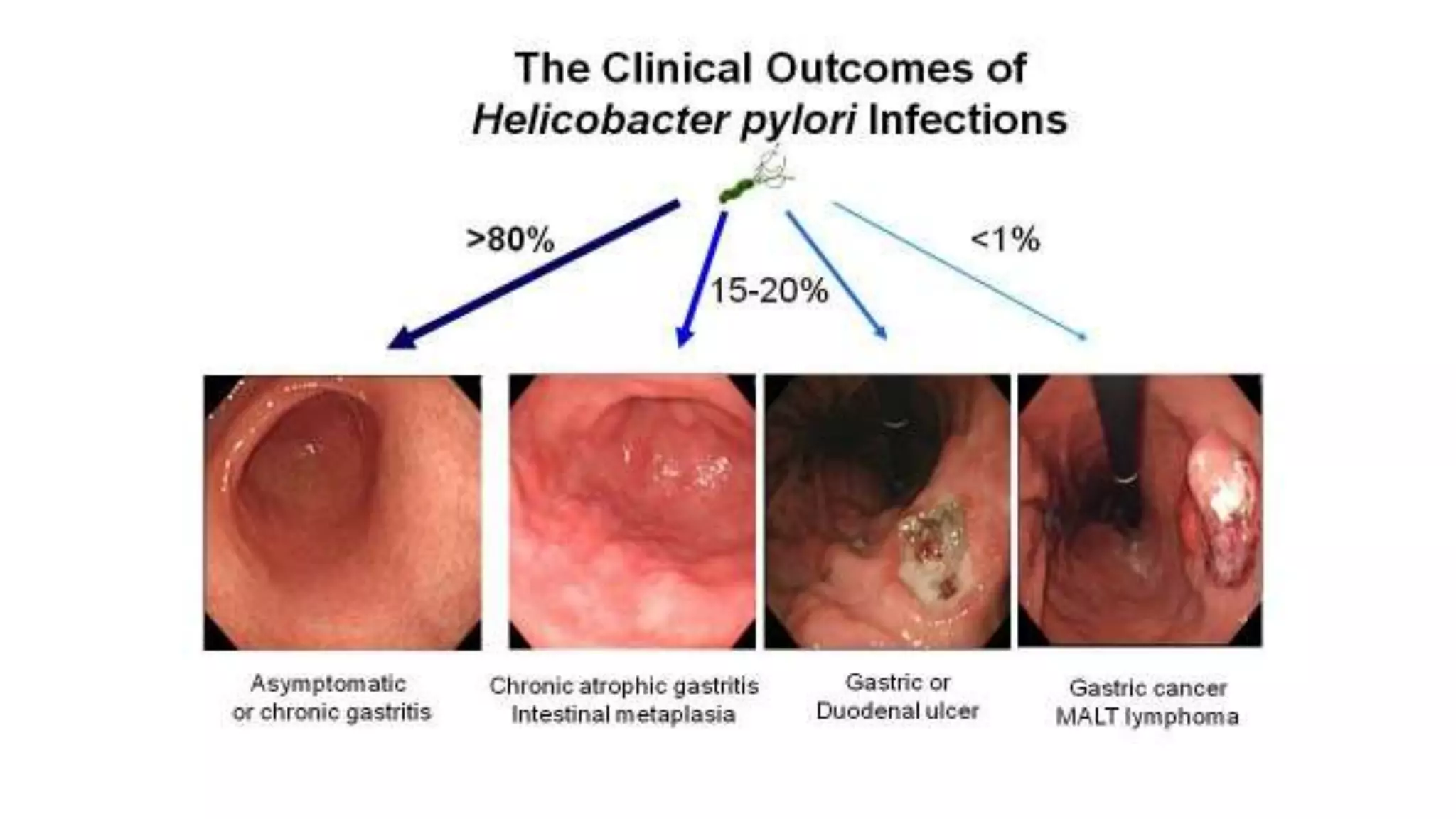 Helicobactor pylori | PPTX
