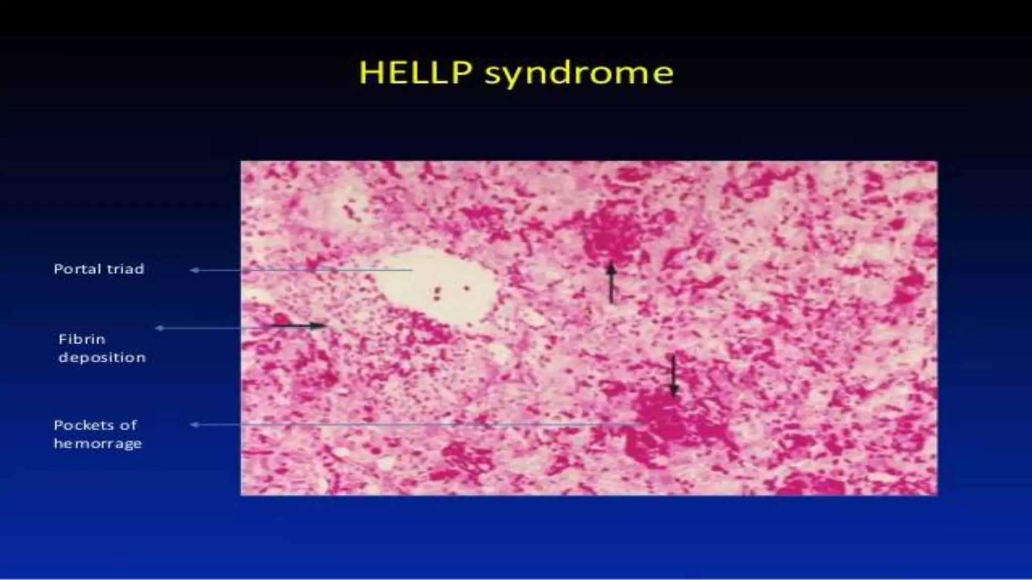 HELLP SYNDROME | PPTX