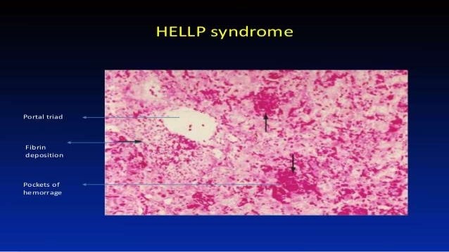 HELLP SYNDROME