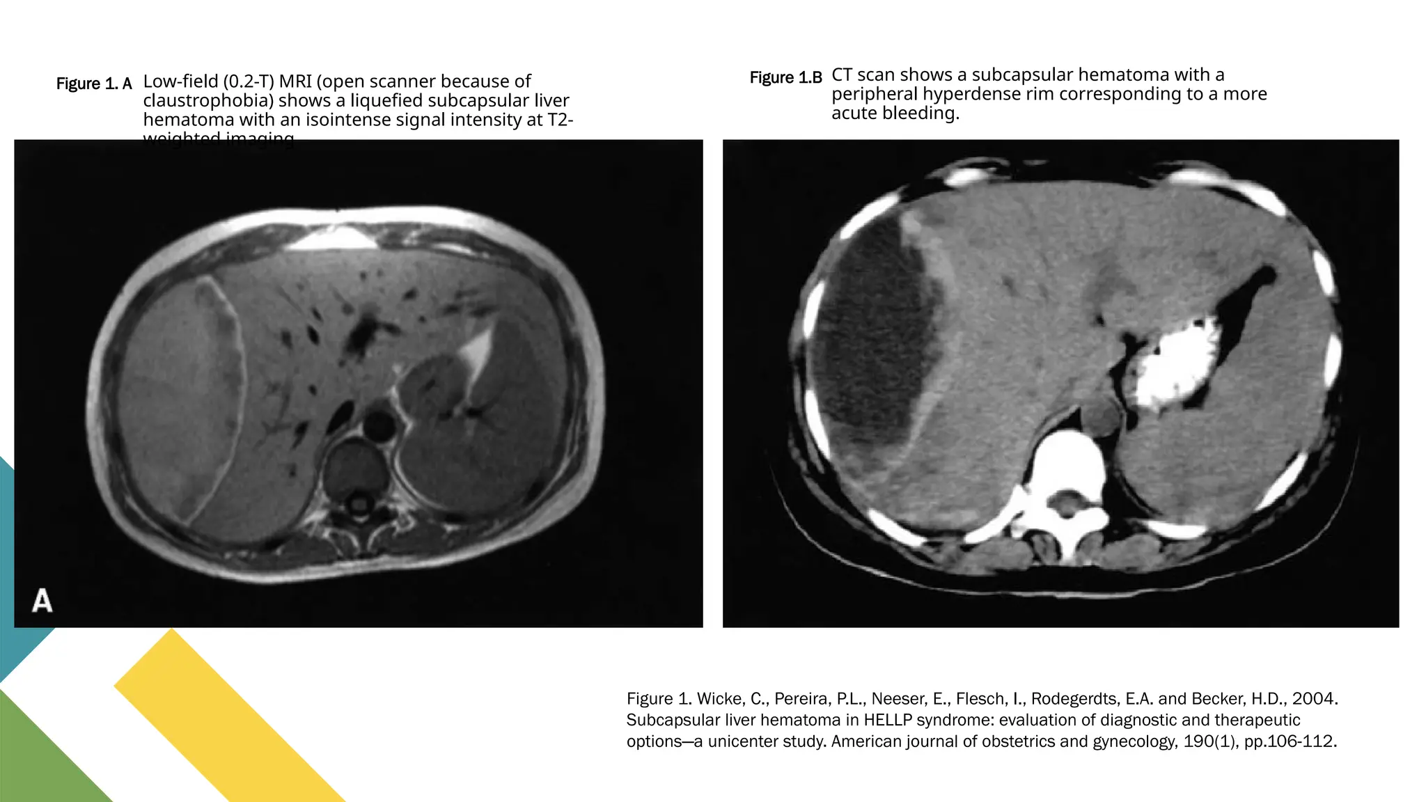 Diagnosis and Management of HELLP syndrome in pregnancy | PPTX