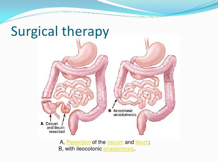 Helminthes Use In Treatment Of Autoimmune Disease