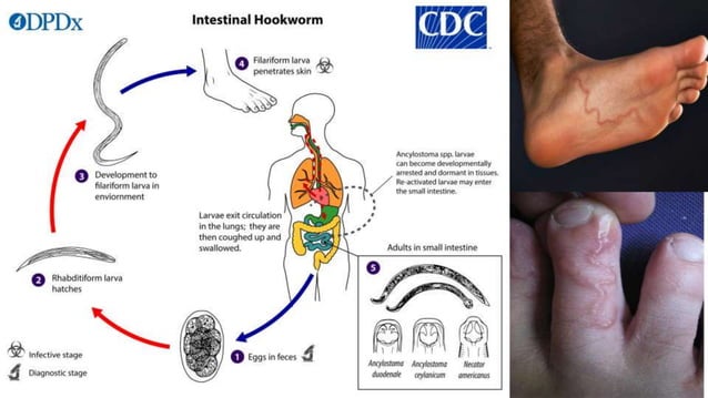 Helminthiasis or Worm infestation in Children for Nursing students | PPTX