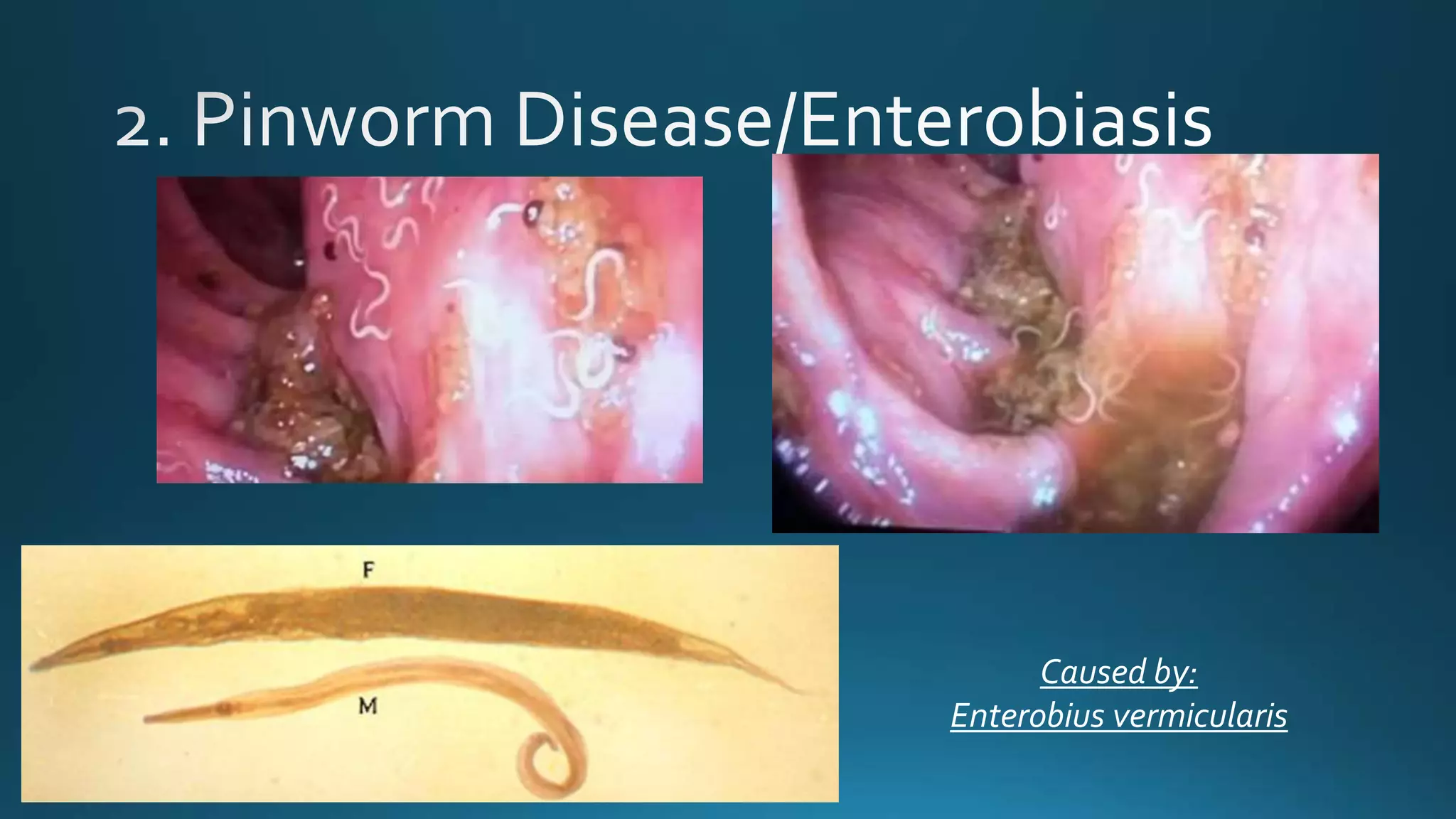 Helminthic diseases of the Digestive System | PPTX