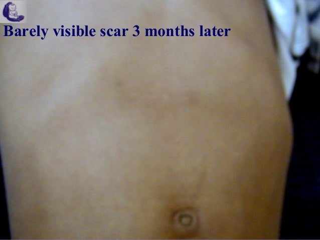 Identifying and Treating Abdominal Lump in Children