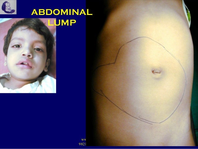 Identifying and Treating Abdominal Lump in Children