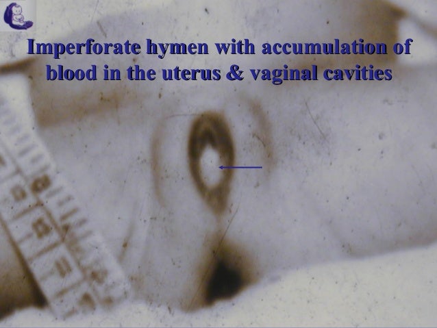 Identifying and Treating Abdominal Lump in Children