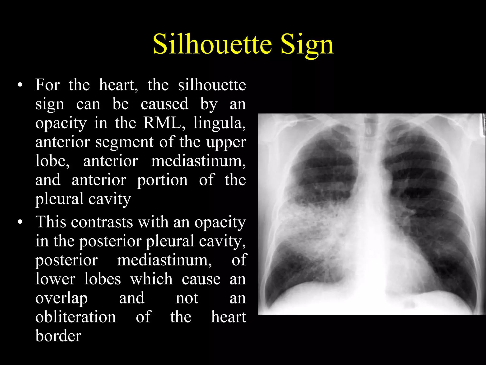 Helpful radiological signs in cxr25 11-91 | PPTX