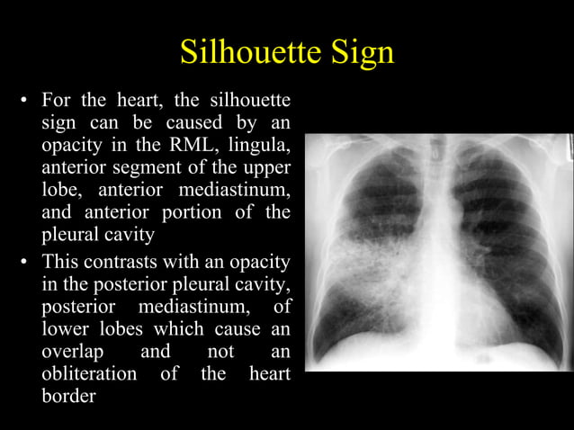 Helpful radiological signs in cxr25 11-91 | PPTX