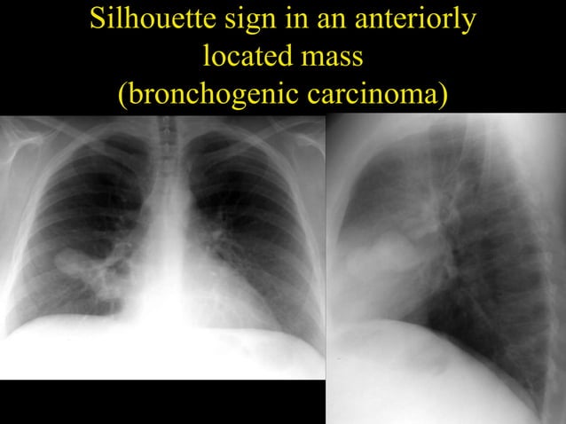 Helpful radiological signs in cxr25 11-91 | PPTX