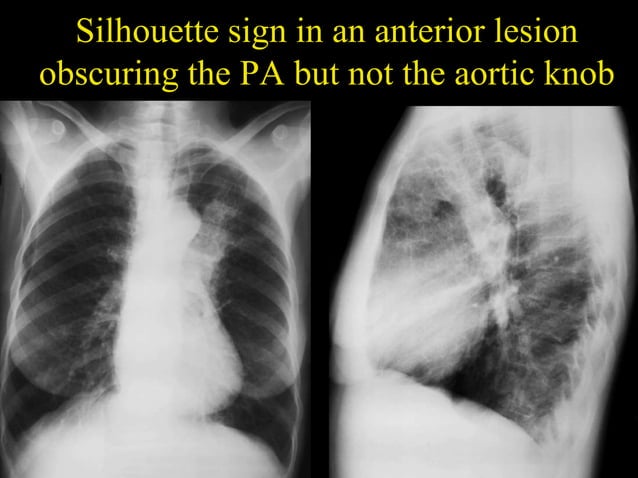 Helpful radiological signs in cxr25 11-91 | PPTX