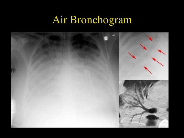 Helpful radiological signs in cxr25 11-91