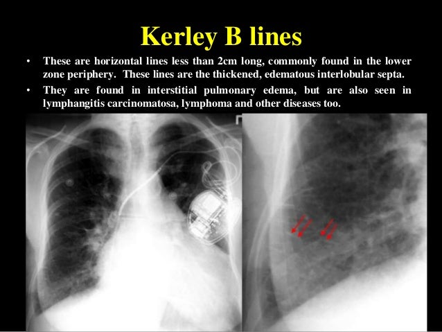 Kerley B Lines Pulmonary Edema