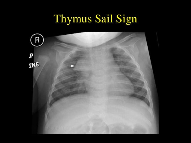 Helpful radiological signs in cxr25 11-91