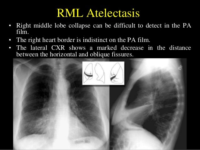Helpful radiological signs in cxr25 11-91