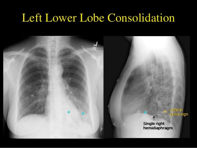 Helpful radiological signs in cxr25 11-91