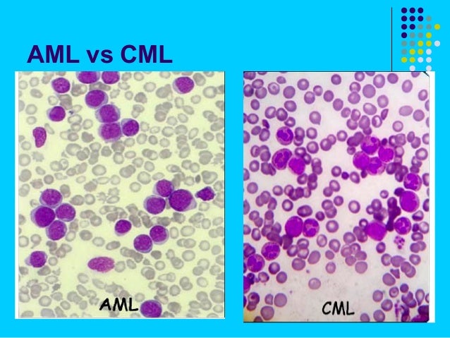 Leukemia