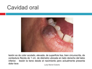 Hemangioma | PPTX