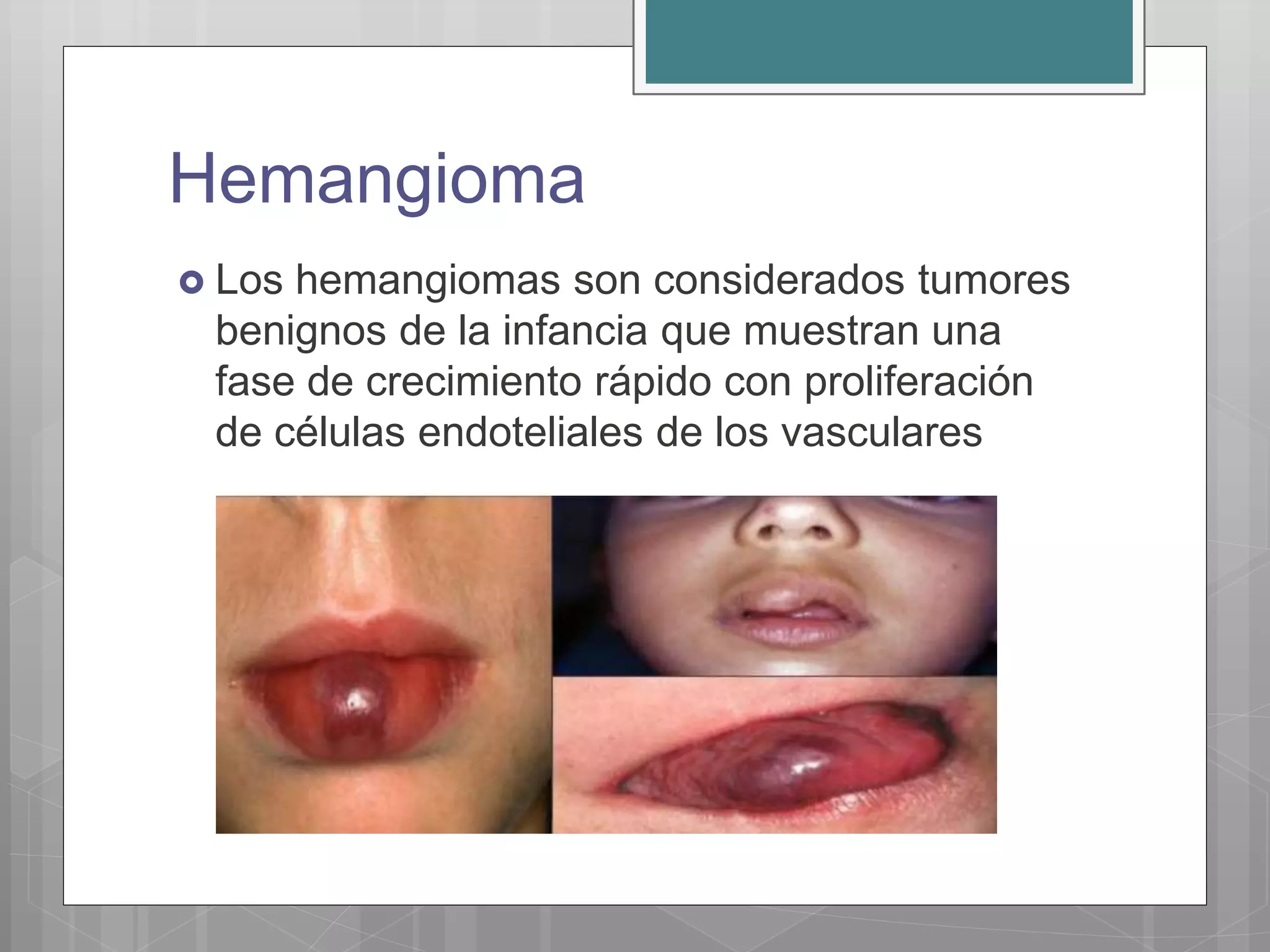 Hemangioma | PPTX