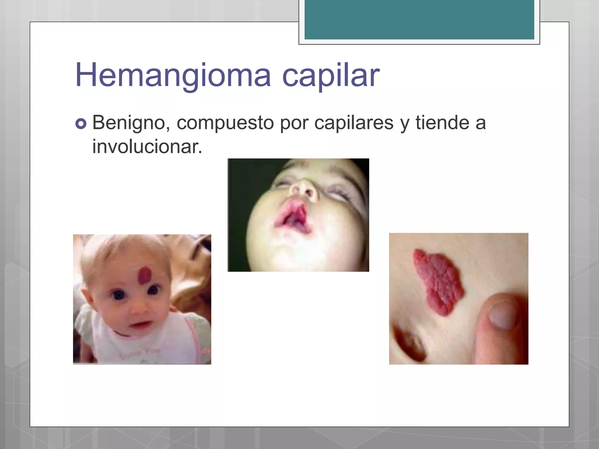 Hemangioma | PPT