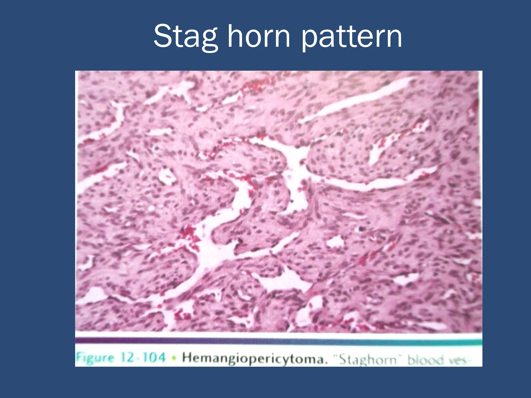 Benign tumoursof connective tissue origin- vascular tumours.pptx