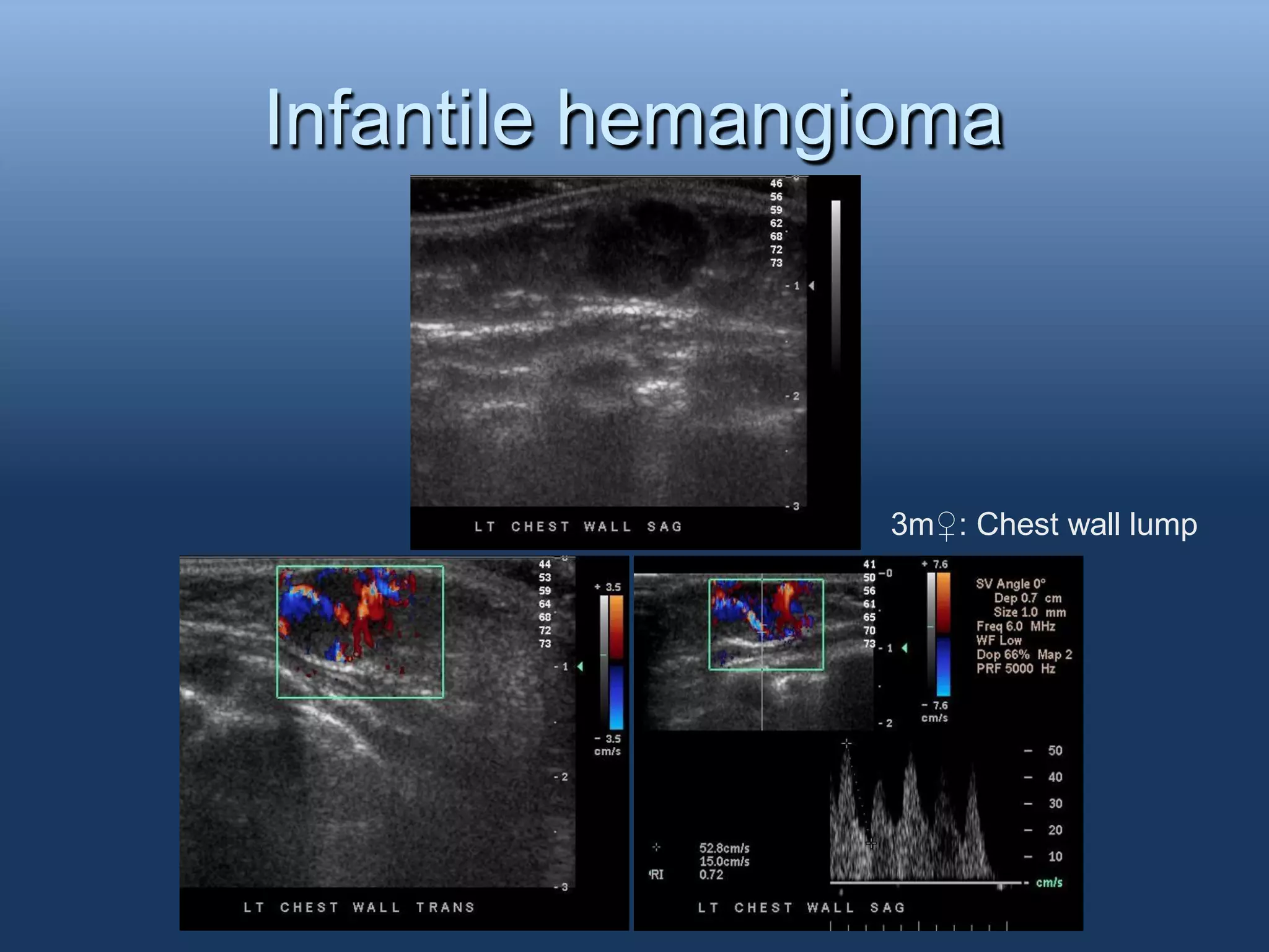 Ultrasound of Vascular anomalies by Oscar M. Navarro | PDF