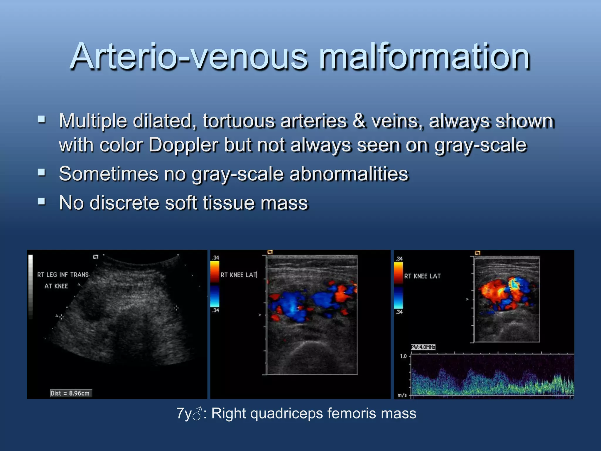 Ultrasound of Vascular anomalies by Oscar M. Navarro | PDF