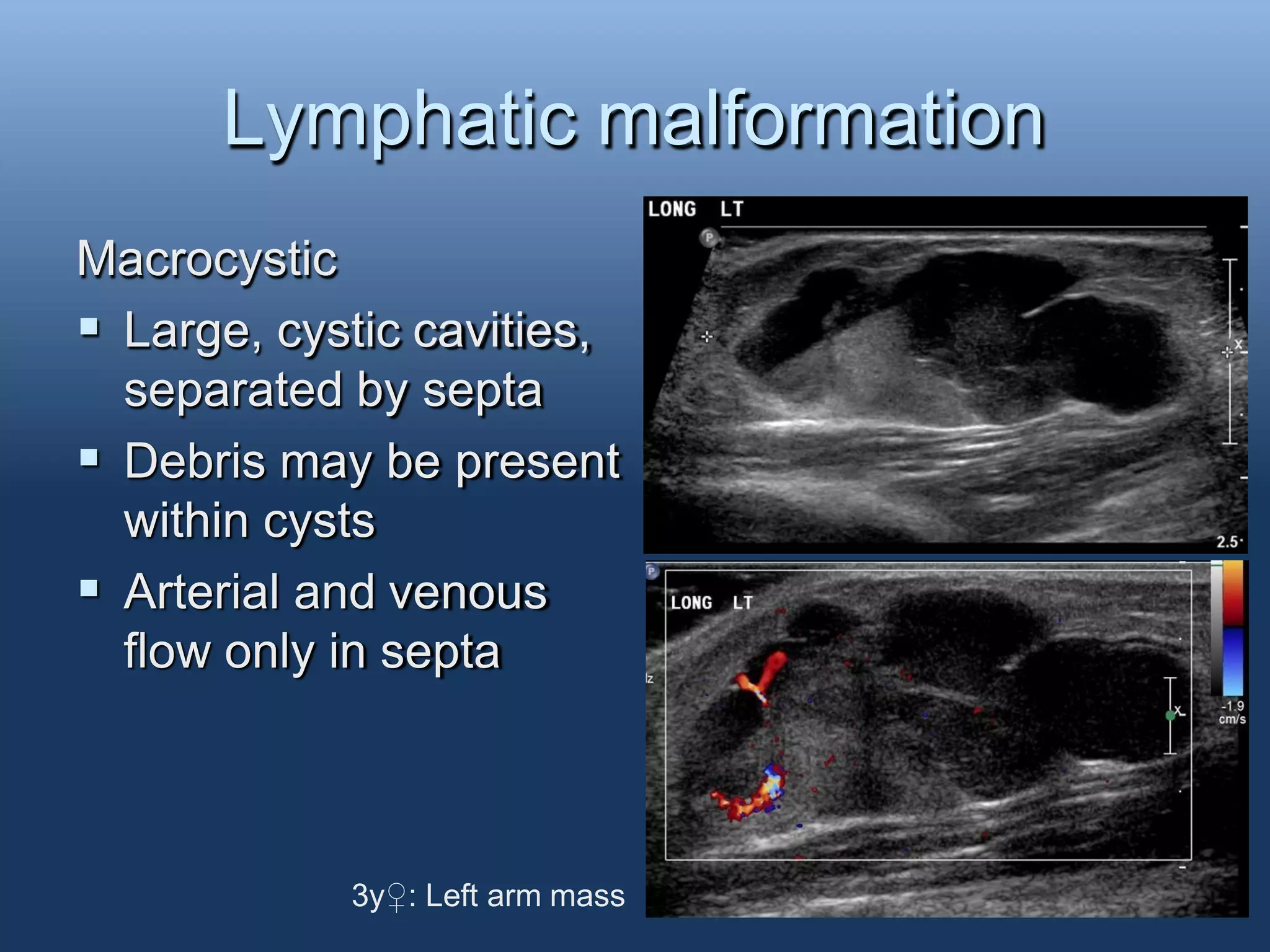 Ultrasound of Vascular anomalies by Oscar M. Navarro | PDF