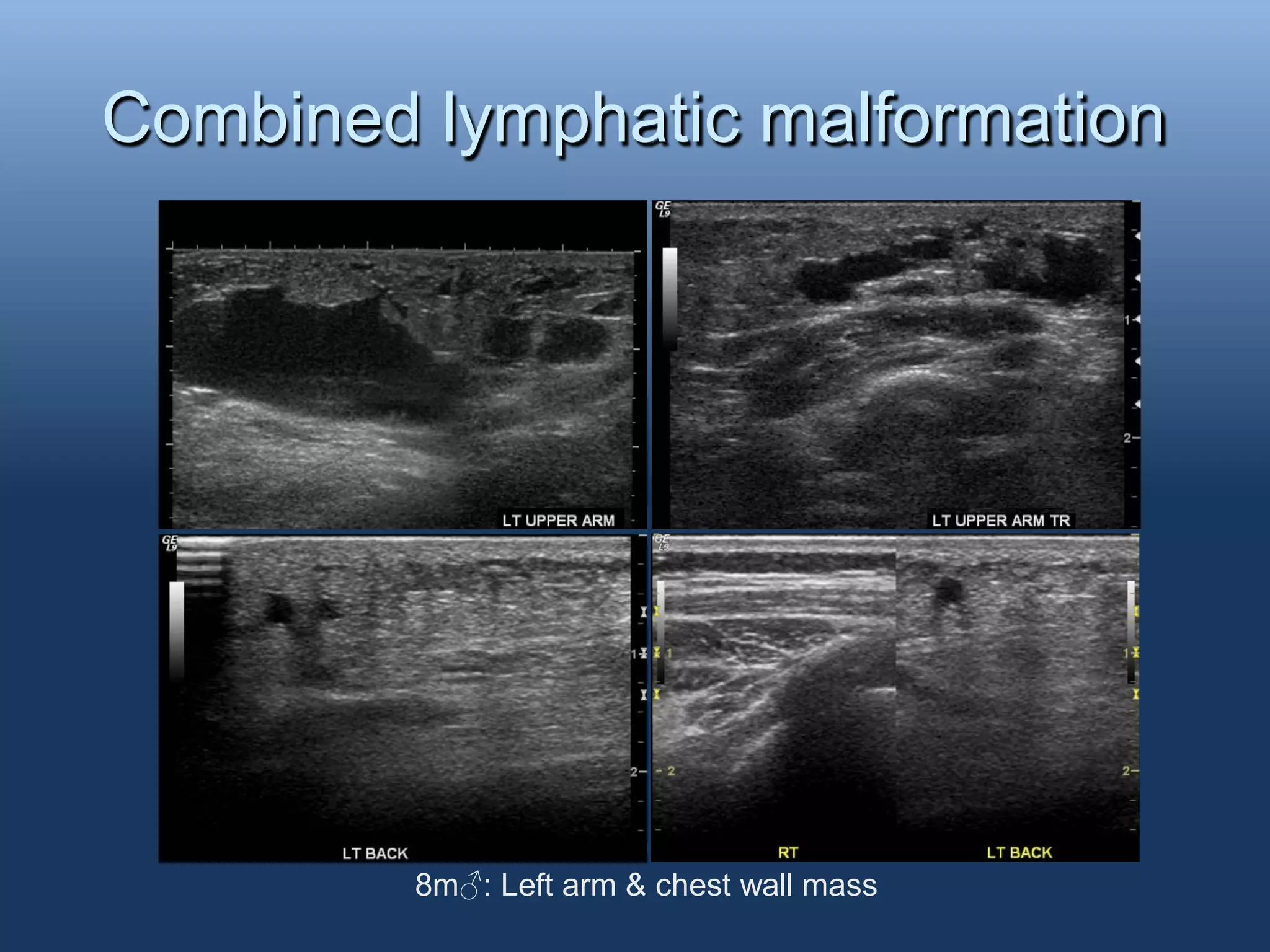 Ultrasound of Vascular anomalies by Oscar M. Navarro | PDF