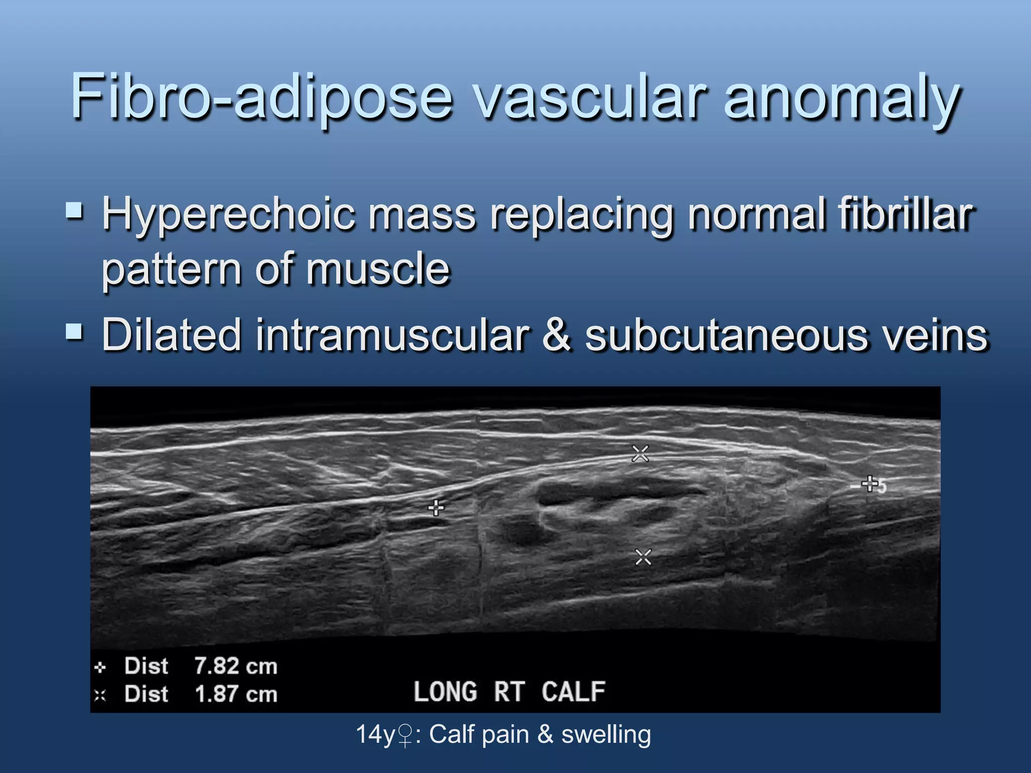 Ultrasound of Vascular anomalies by Oscar M. Navarro | PDF