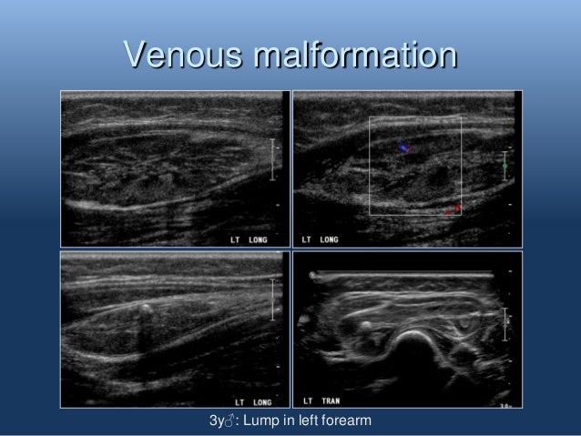 Ultrasound of Vascular anomalies by Oscar M. Navarro