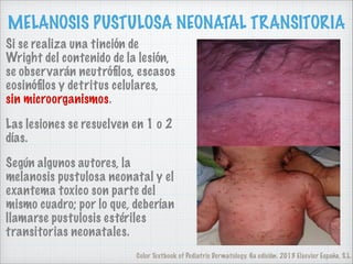 Eritema Tóxico Vs Melanose Pustulosa