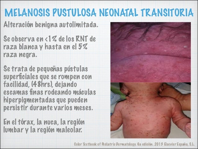 Hemangiomas infantiles