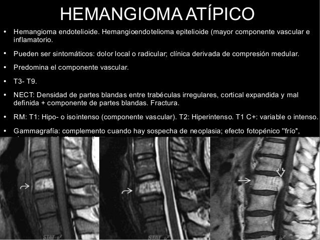 Quotminquot Vertebral Hemangioma Vertebral Angioma Symptoms