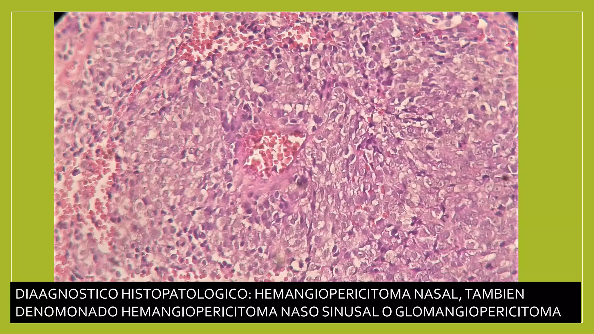 Hemangiopericitoma nasosinusal en un canino | PDF