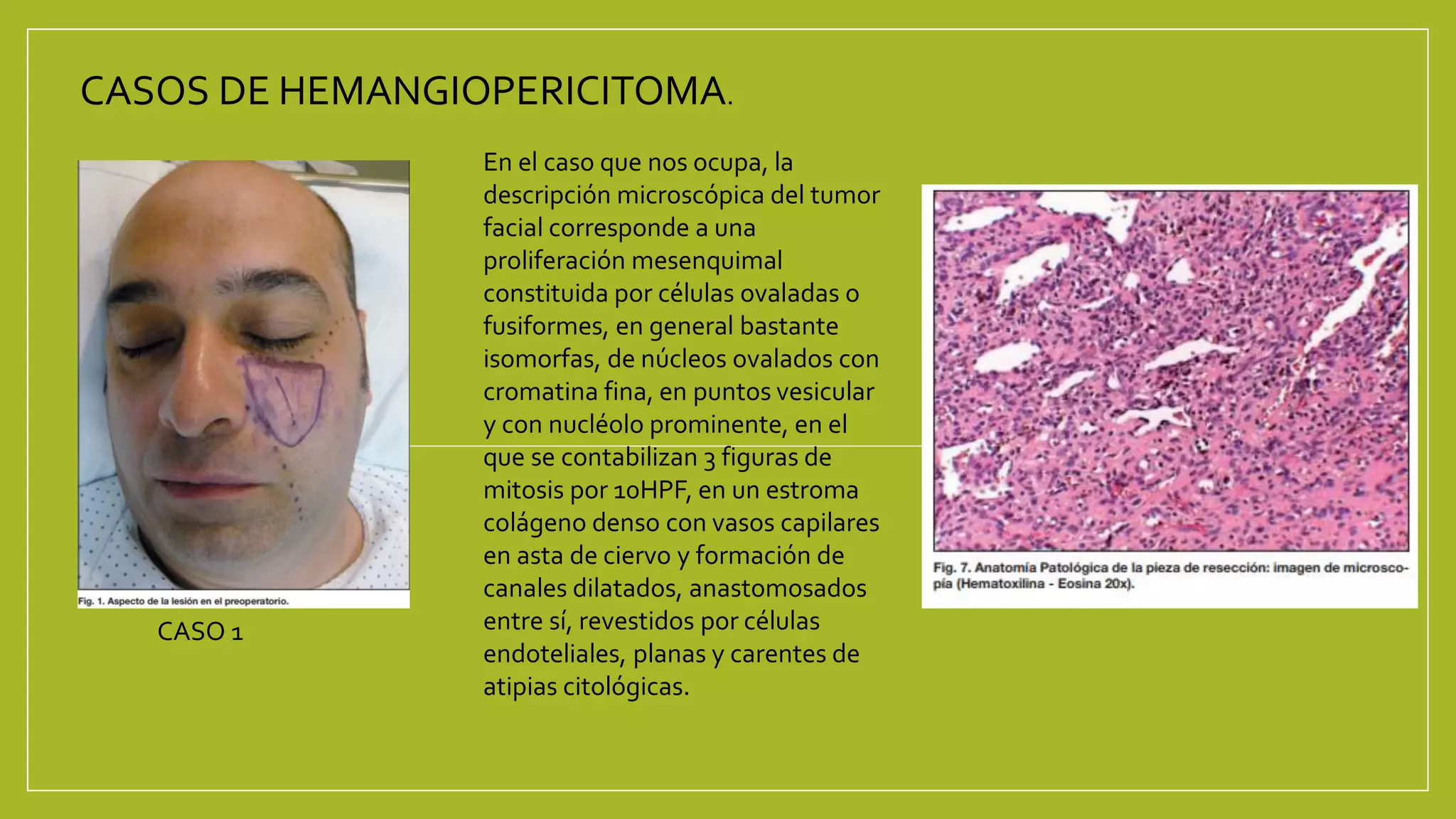 Hemangiopericitoma nasosinusal en un canino | PDF