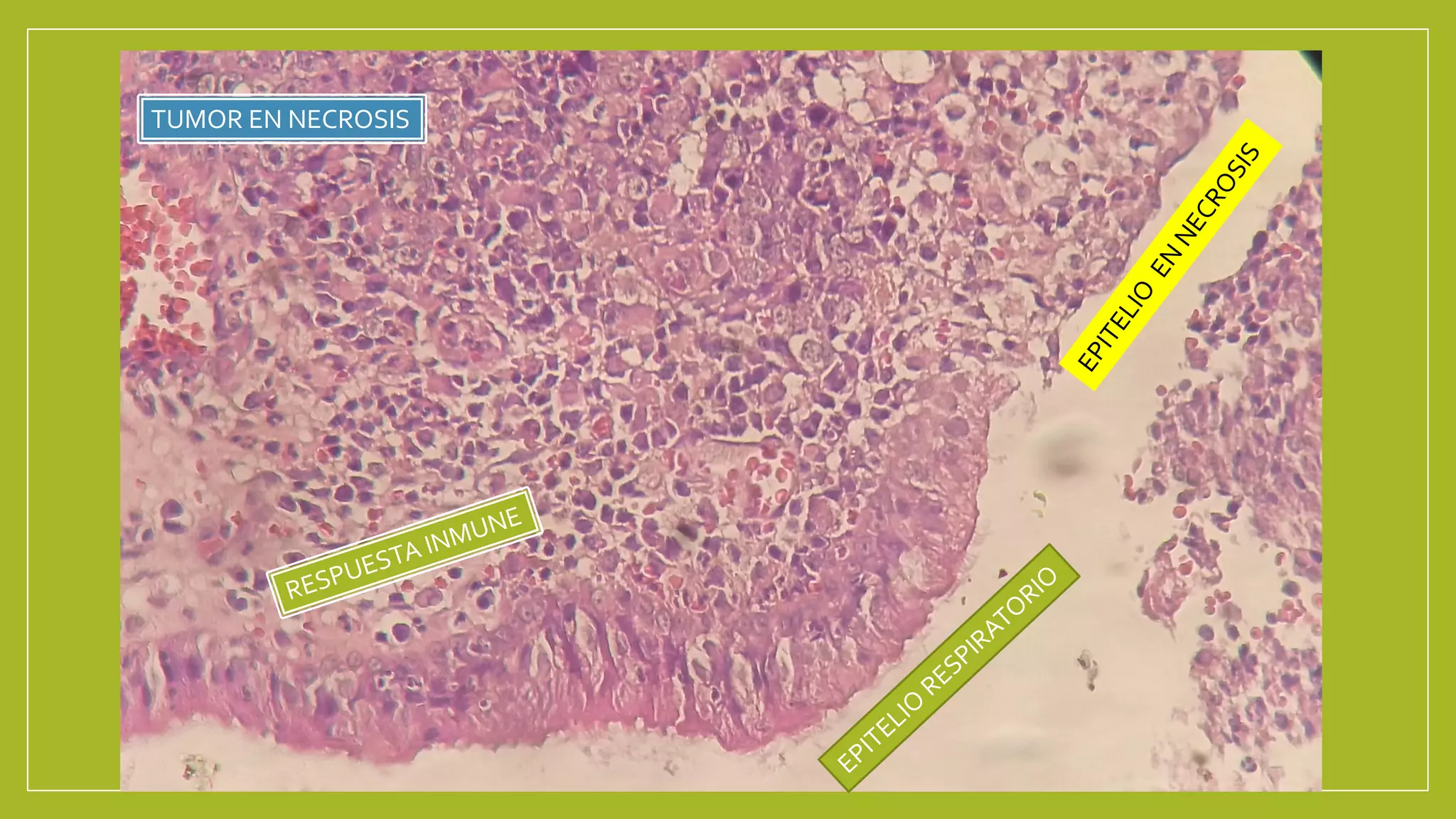 Hemangiopericitoma nasosinusal en un canino | PDF