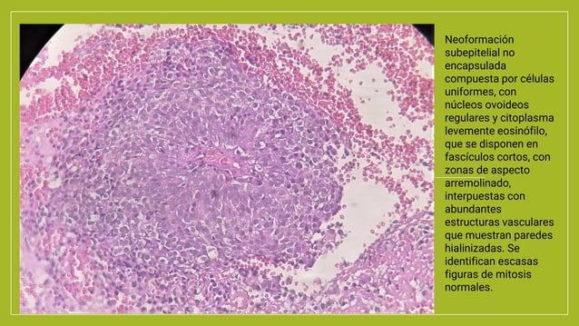 Hemangiopericitoma nasosinusal en un canino | PDF