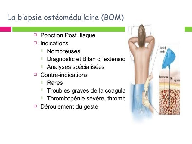 Biopsie Ostéo Médullaire Et Myélogramme – TEOMJG