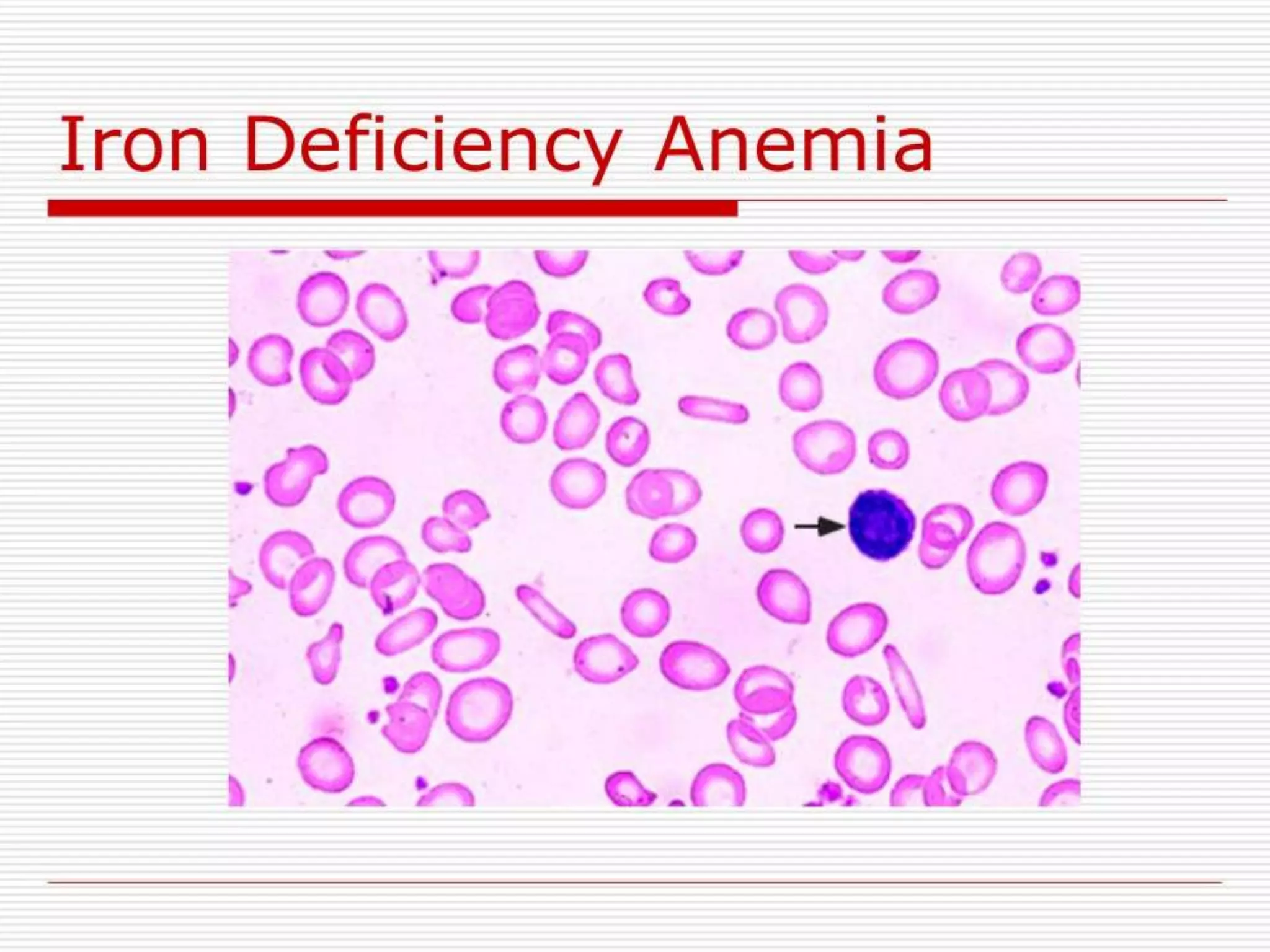 Anemia, Microcytic Hypochromic and Macrocytic anemia | PPT
