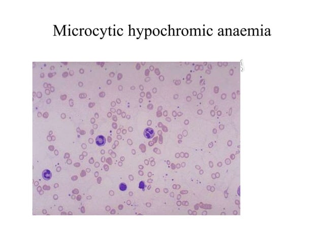 Anemia, Microcytic Hypochromic and Macrocytic anemia | PPT | Blood ...
