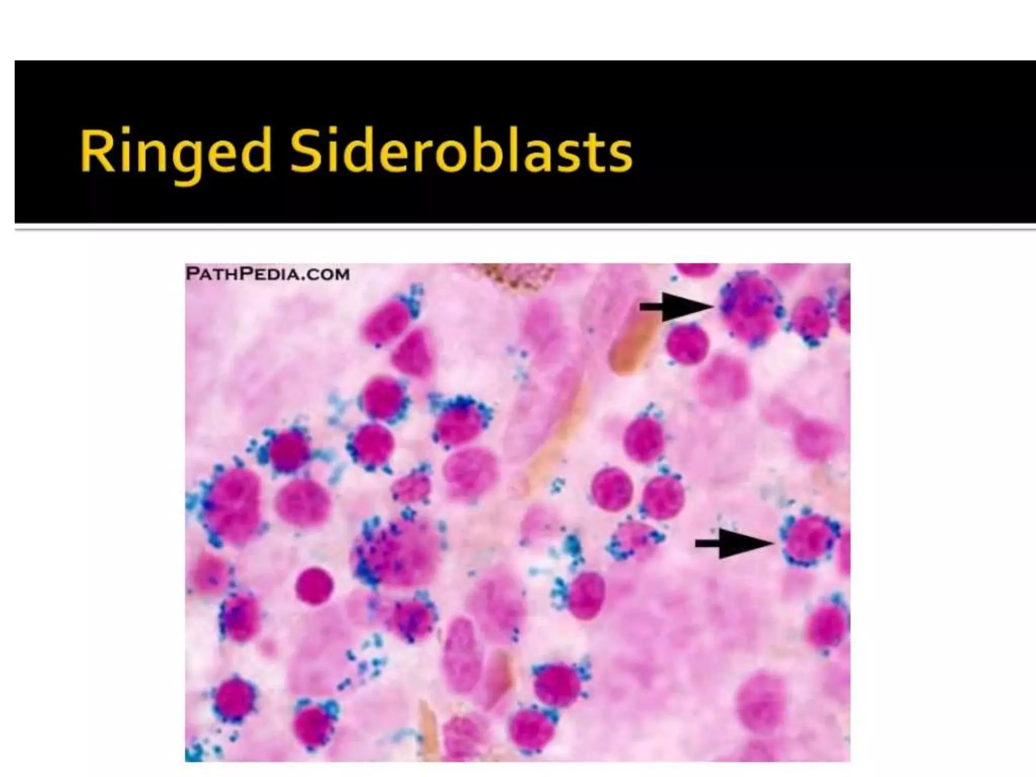Pancytopenia and Aplastic anaemia, sideroblastic Anemia | PPT