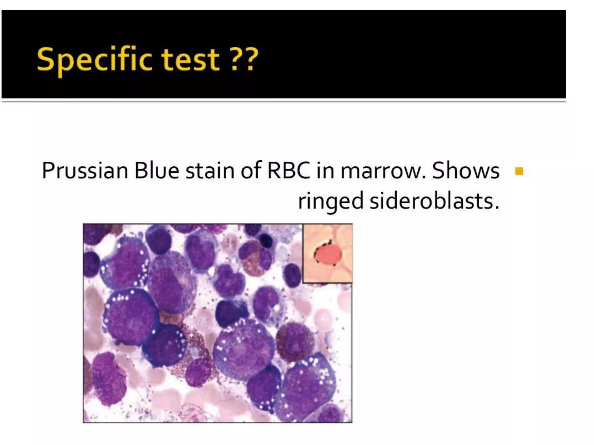 Pancytopenia and Aplastic anaemia, sideroblastic Anemia | PPT