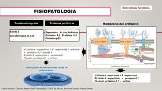 Esferocitosis hereditaria. Pediatría y puericultura | PPTX