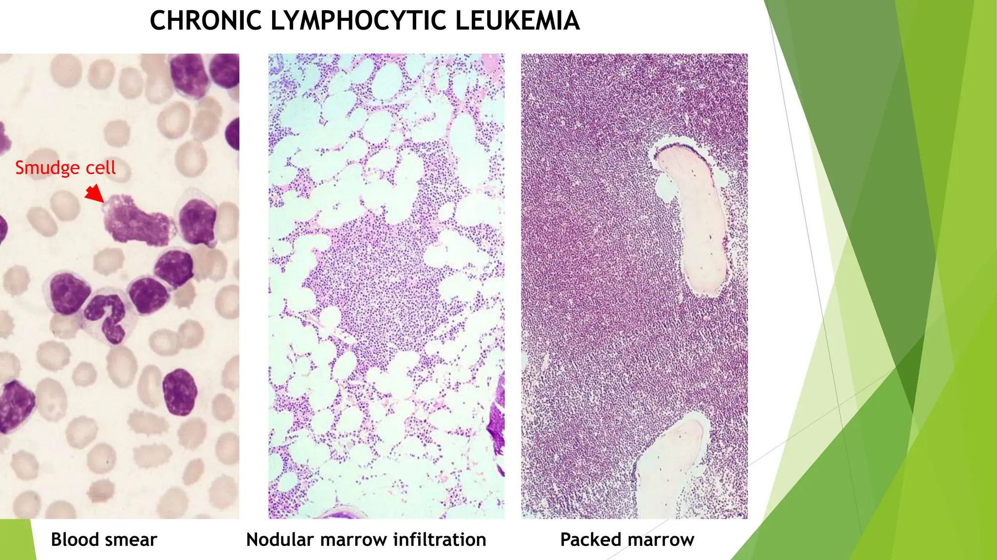 Hematological Malignancies-leukemias.pptx