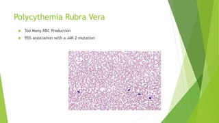 Hematological Malignancies-leukemias.pptx