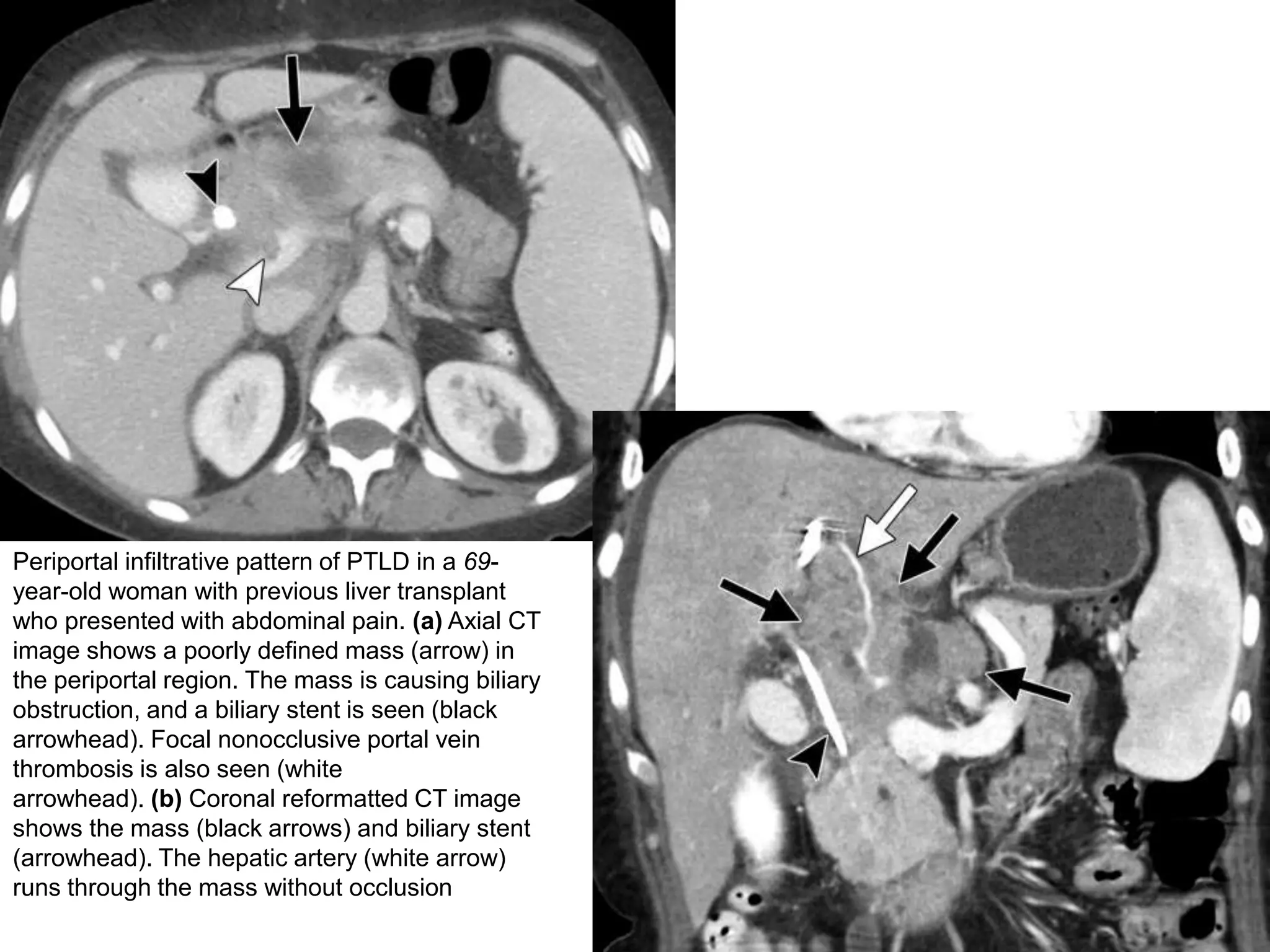 Hematologic malignancies of the liver | PPTX