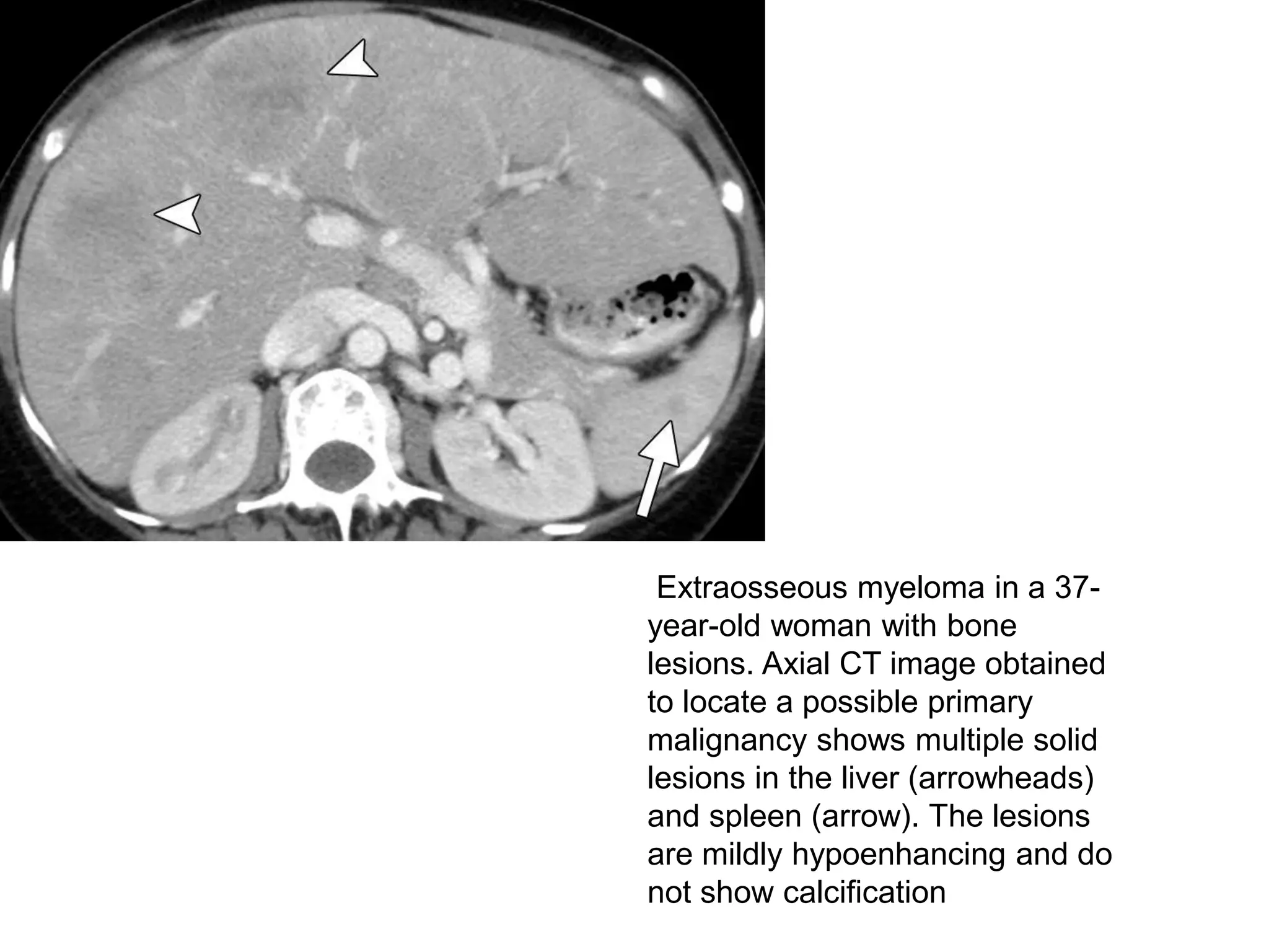 Hematologic malignancies of the liver | PPTX