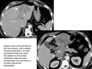 Hematologic malignancies of the liver | PPTX