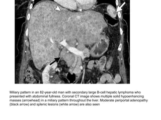 Hematologic malignancies of the liver | PPTX