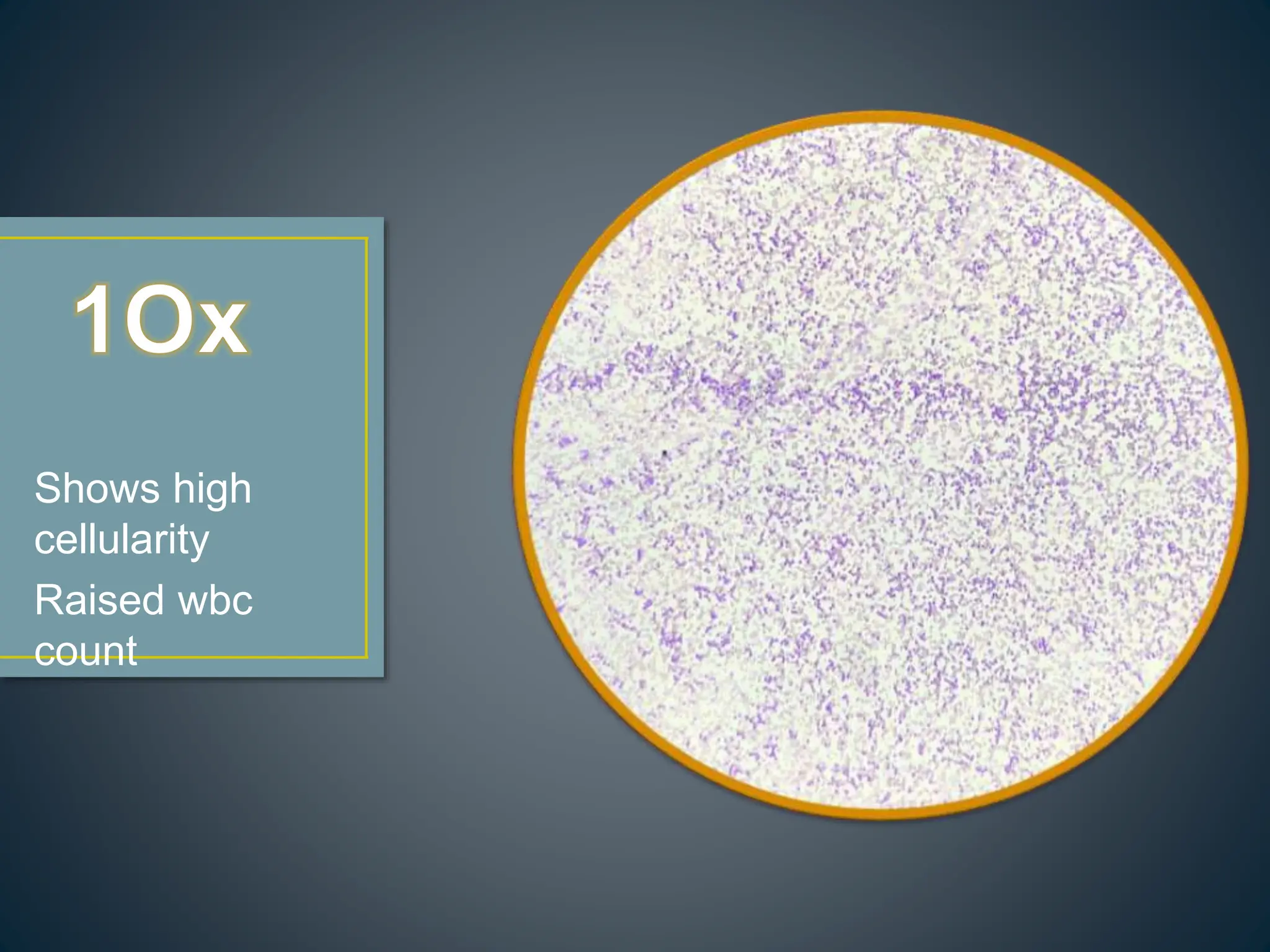 hematology equas case of acute leukemia.pptx